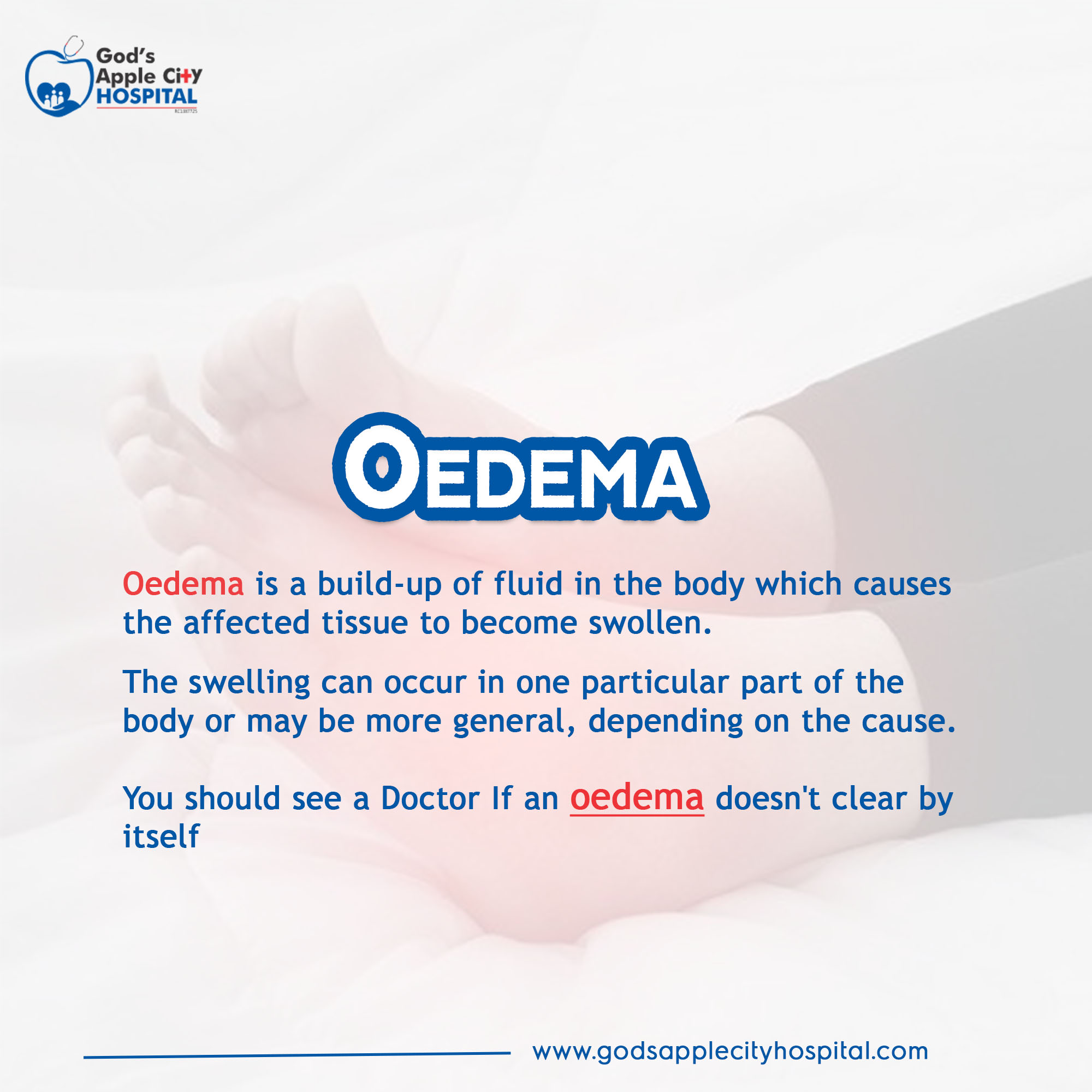 Oedema (Swollen Ankles, Feet and Legs) – God's Apple City Hospital